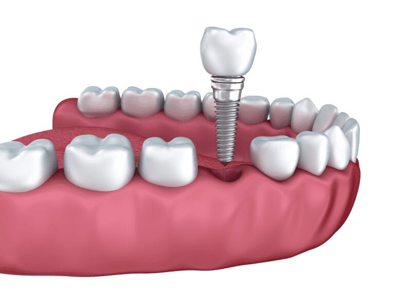 All-on-4, All-on-6 and All-on-8 Dental Implants