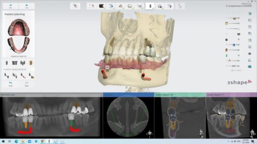 Computer Guided Implant Surgery in Bangkok, Thailand