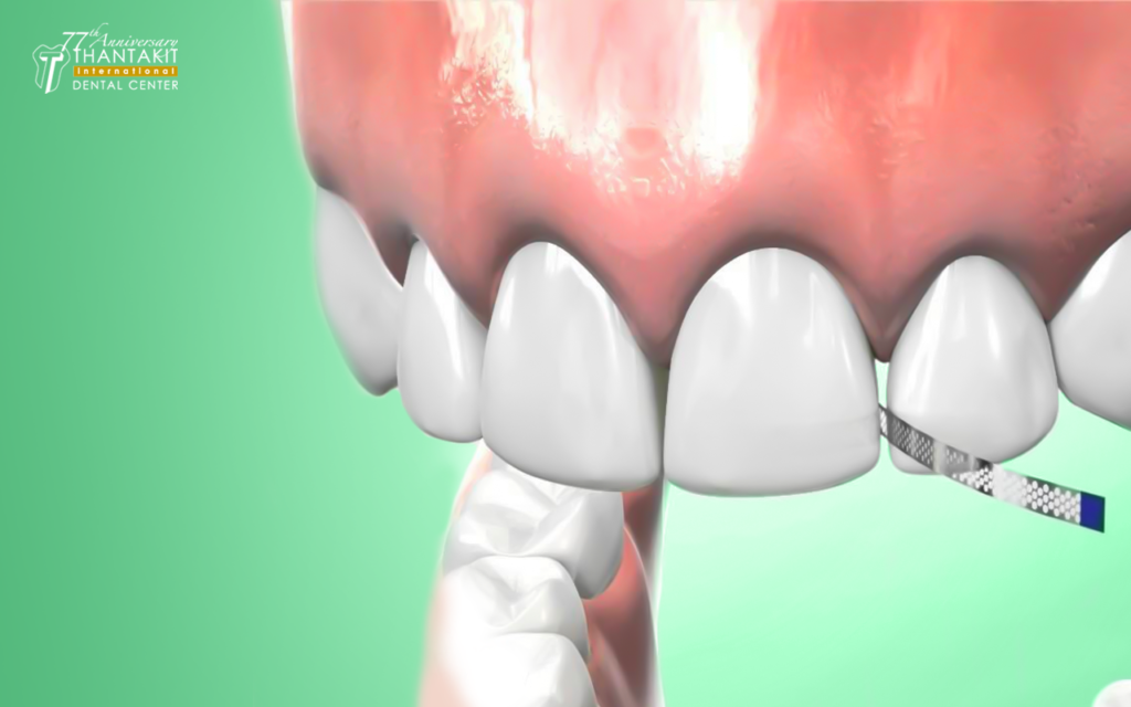 ไขข้อสงสัย IPR คือ อะไร ทำไมต้องทำก่อนจัดฟันใส | ศูนย์ทันตกรรมทันตกิจ